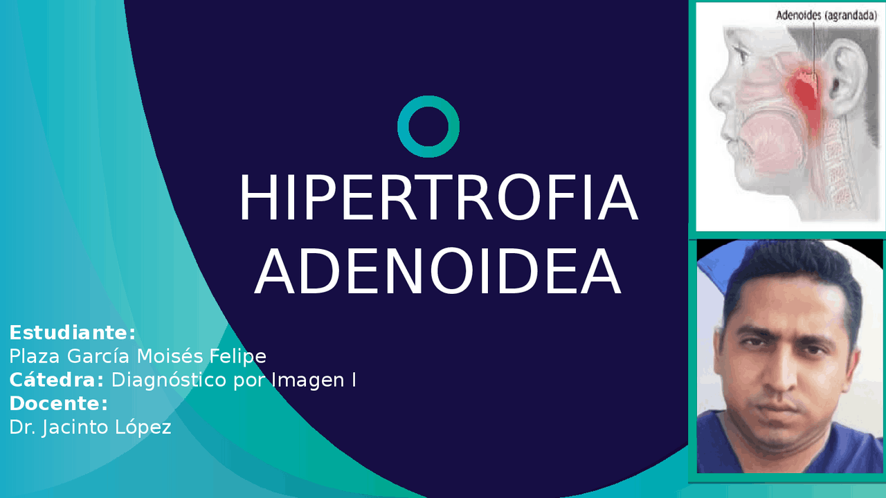 Hipertrofia de adenoides - Docsity