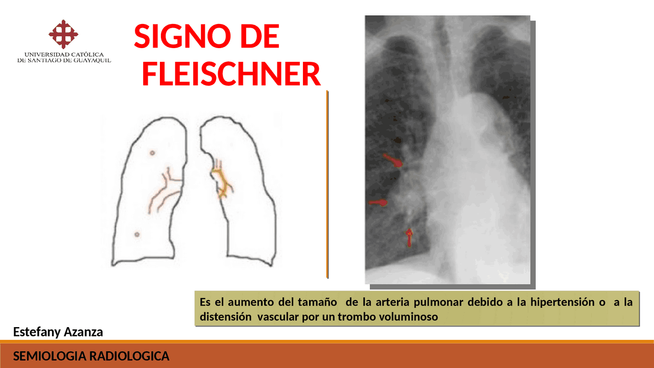 Signo de Fleischner Signo de Fleischner Signo de Fleischner Signo de ...