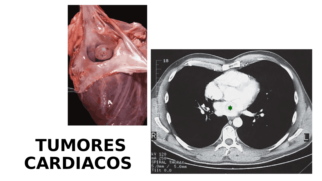 Tumores del Corazon e sus caracteristicas - Docsity