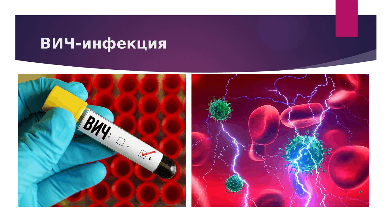 Презентация по ВИЧ инфекции Docsity