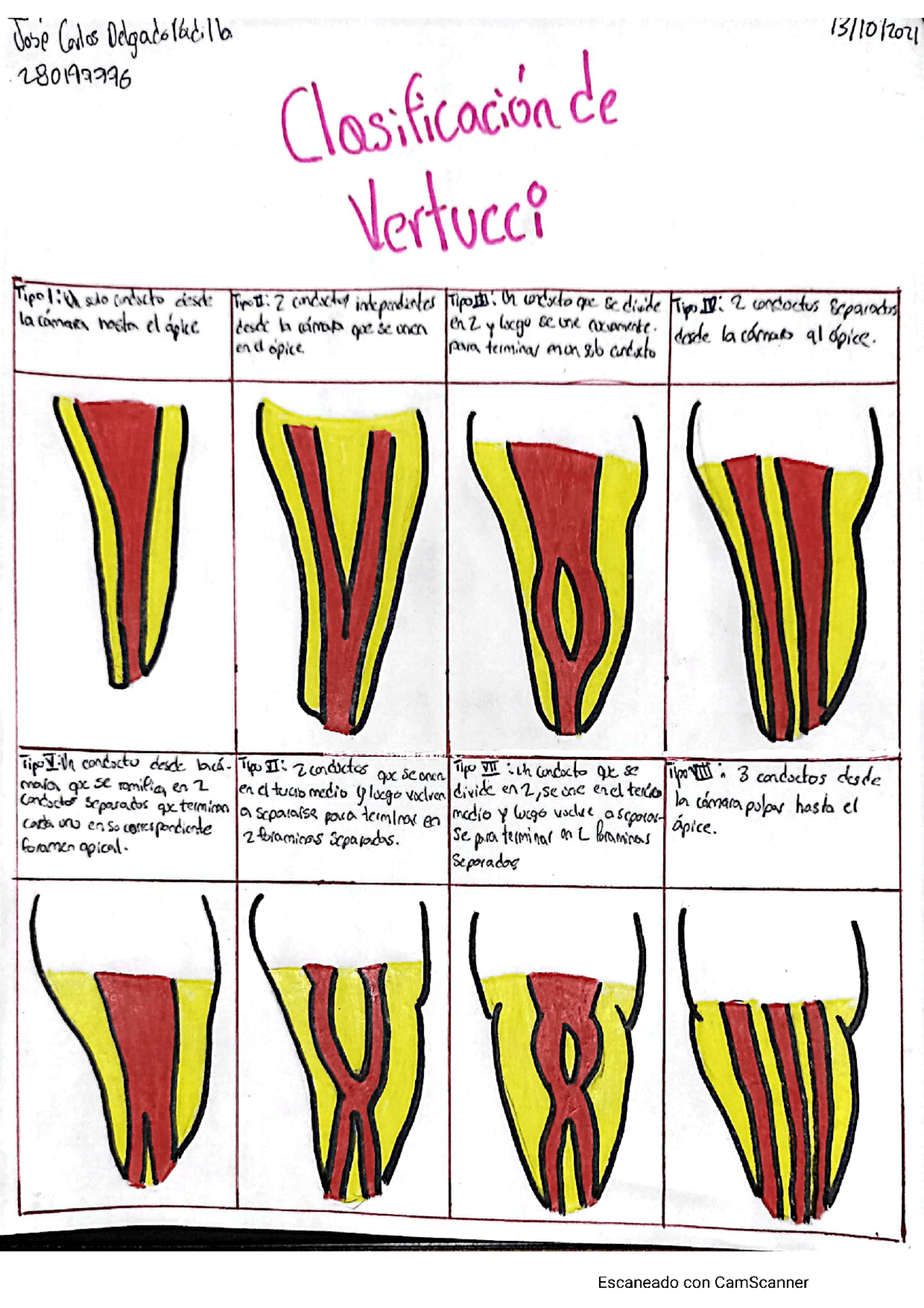 Clasificación de Vertucci | Transcripciones de Endodoncia | Docsity