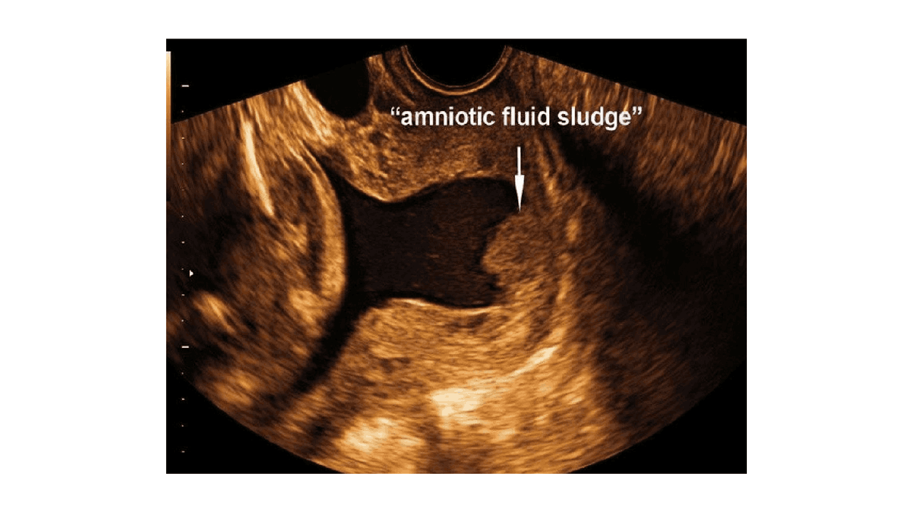 Cervicometria para parto pretermino - Docsity