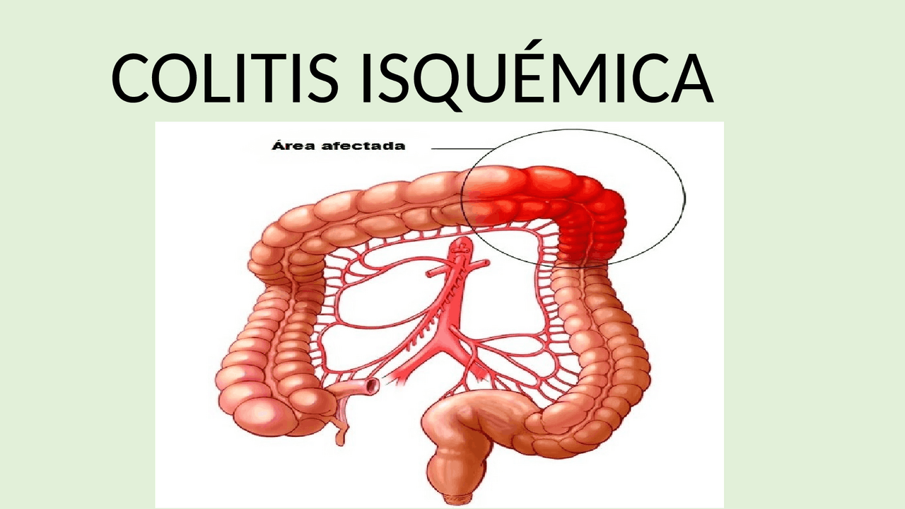 Descripcion de la colitis isquemica - Docsity