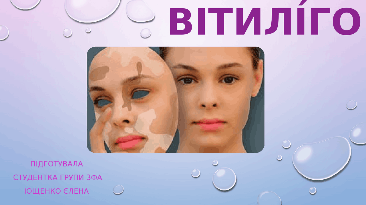 Вітиліго визначення цікаві факти Презентации Биология Docsity