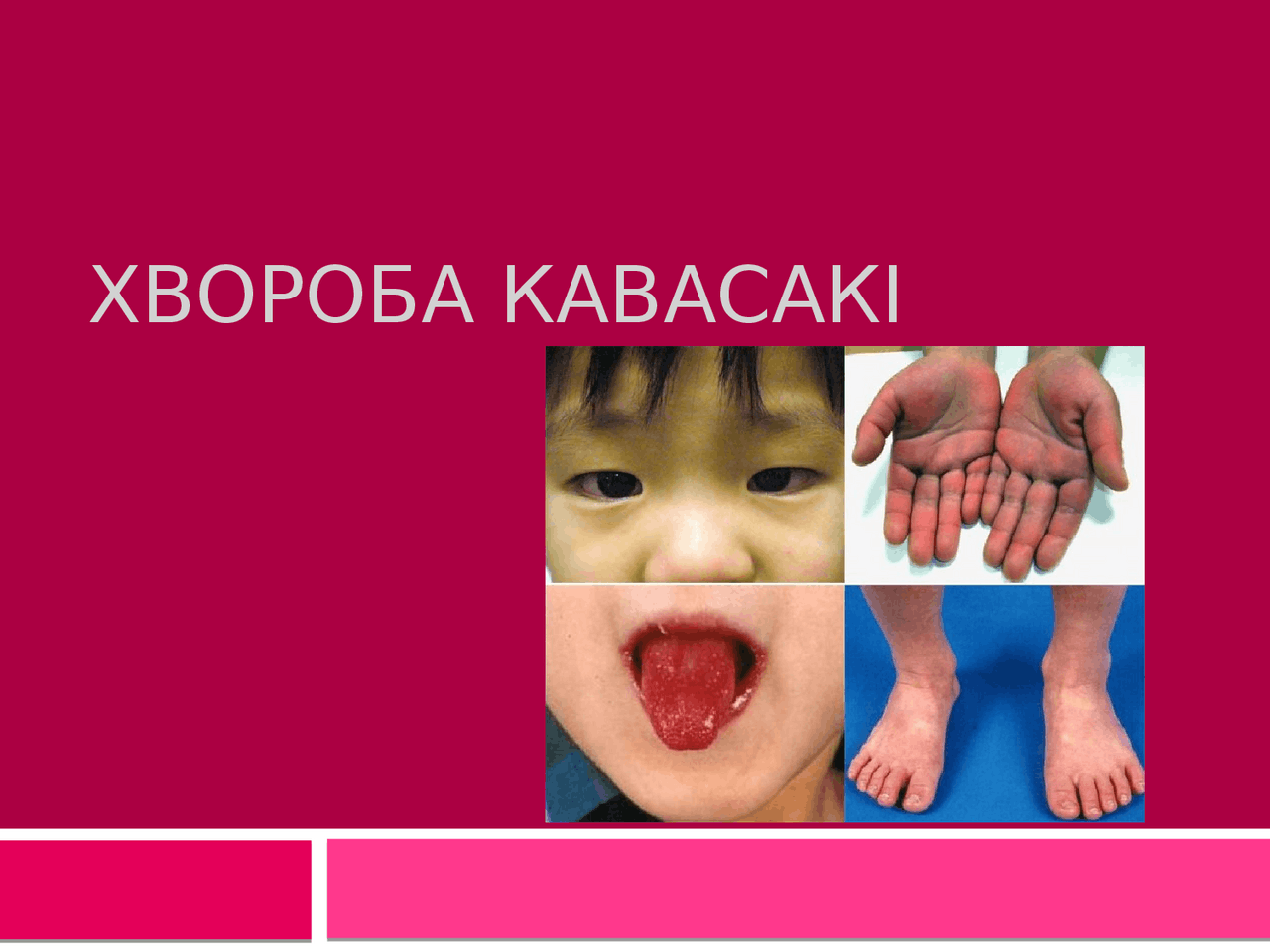 Презентація на тему Хвороба Кавасакі Docsity