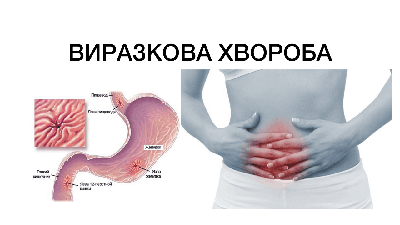 Виразкова хвороба шлунка і 12 палої кишки Презентации Терапия Docsity