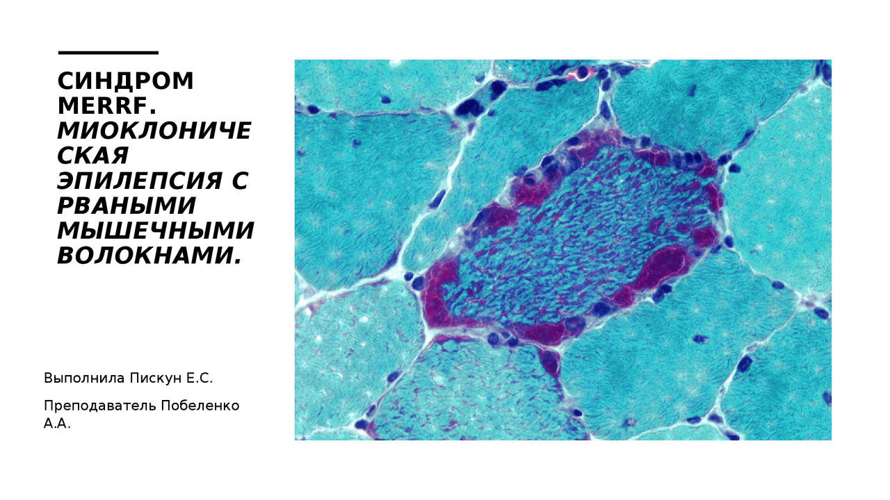 презентация по теме "Синдром MERRF" - Docsity