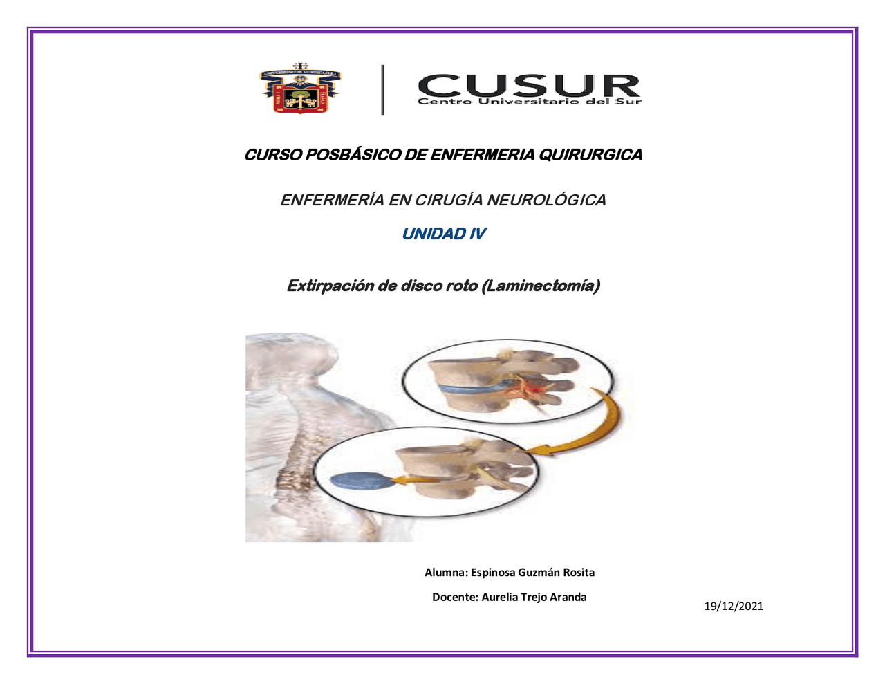 Extirpación de disco roto (Laminectomía) - Docsity