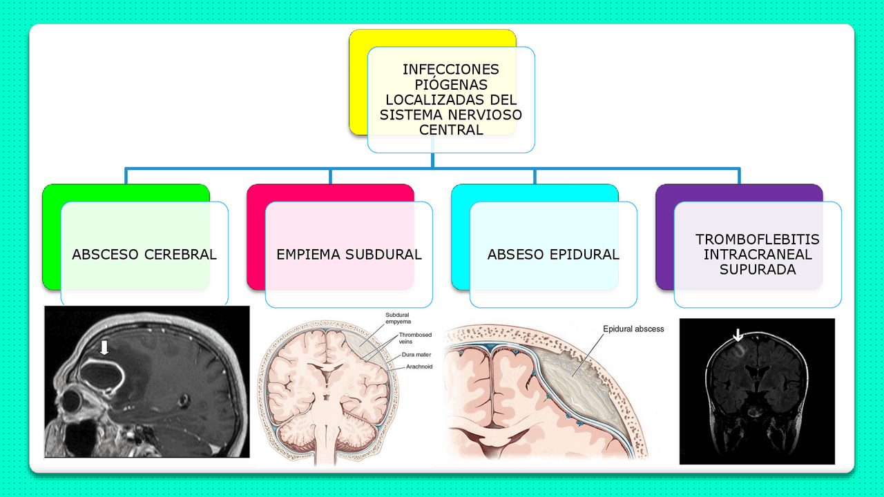 Tratamiento y manejo de empiema subdural en pediatria | Diapositivas de ...
