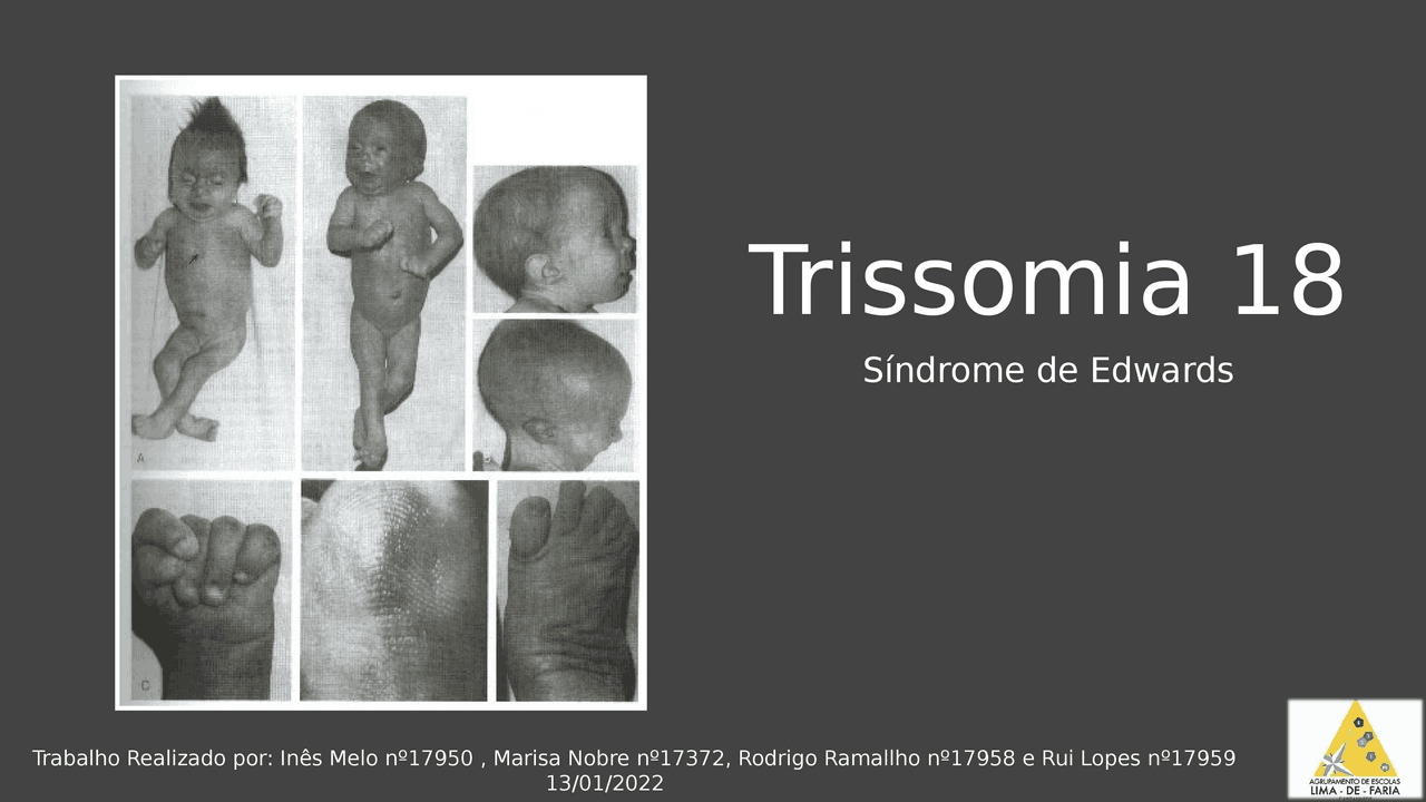 Resumo de trissomia - Docsity