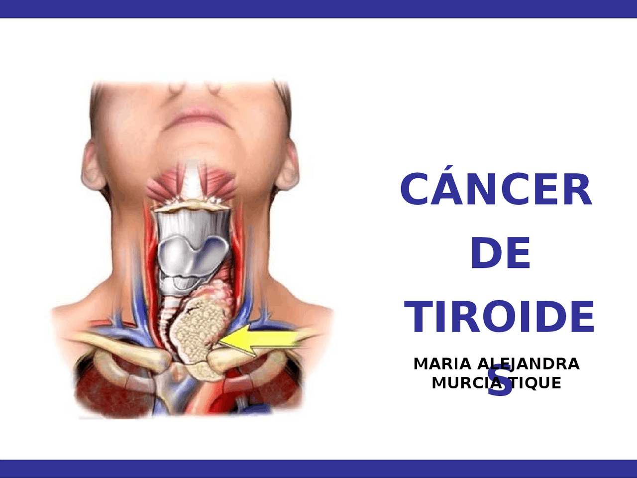 Cancer De Tiroides Cirugia General Docsity