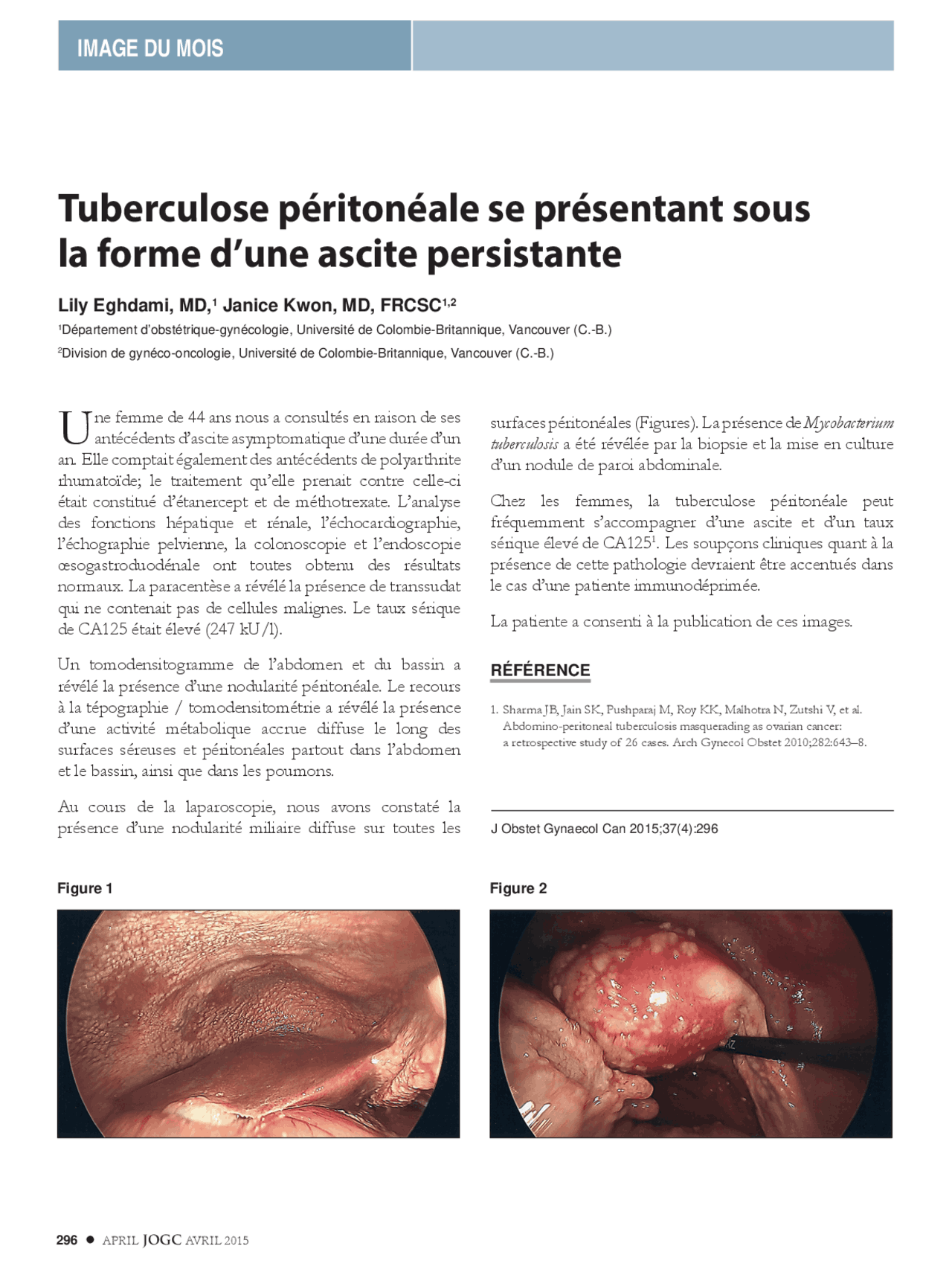 Tuberculose péritonéale se présentant sous la forme d’une ascite persistante - Docsity