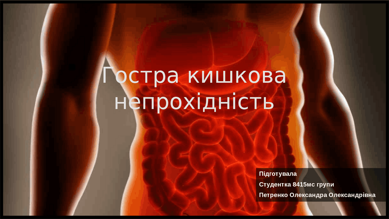 Гостра кишкова непрохідність Docsity