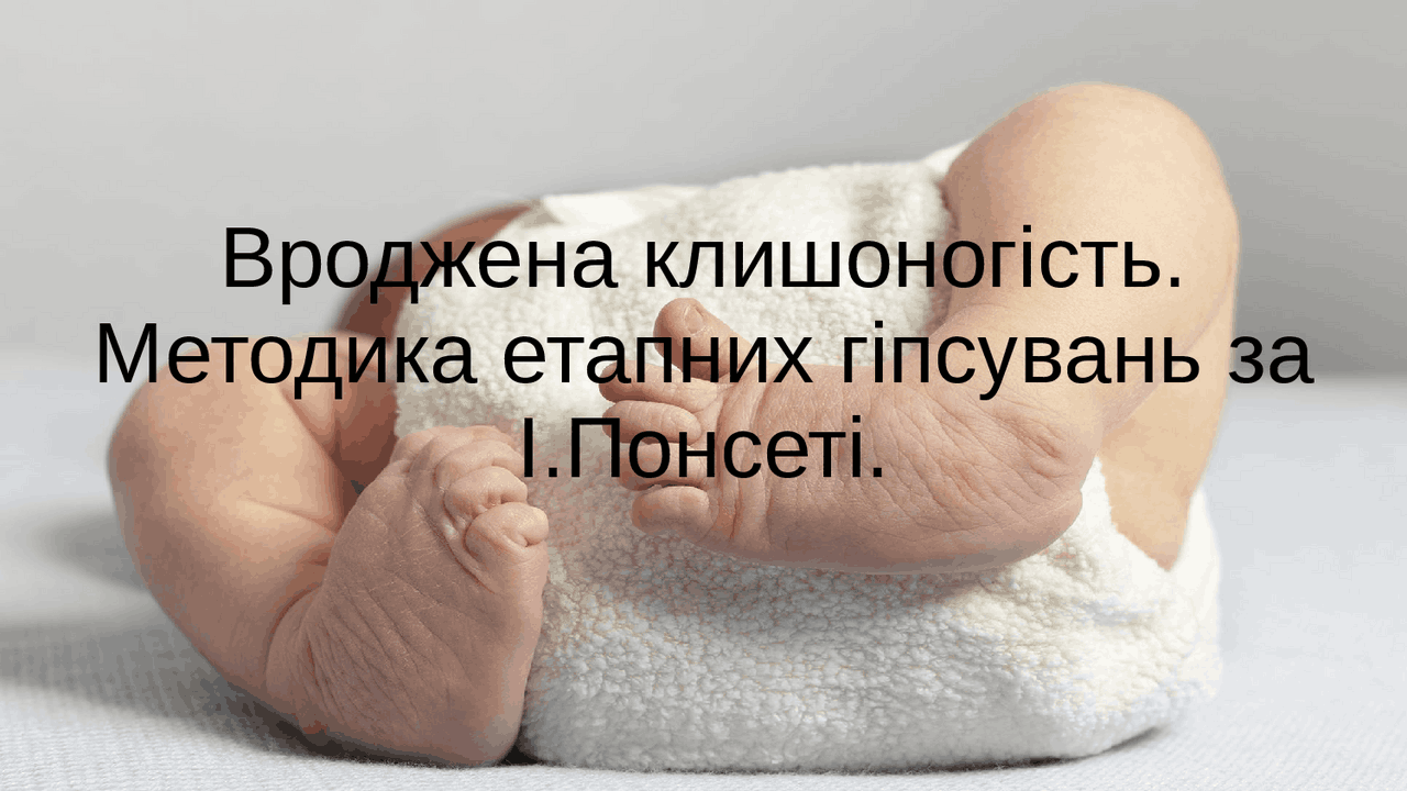Презентація вроджена клишоногість Презентации Ортопедия Docsity