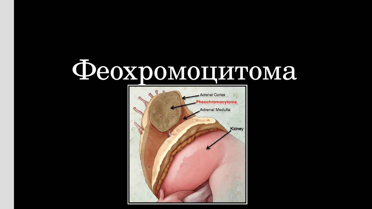 Феохромоцитома пухлина з хромафінних клітин дифузної нейроендокринної