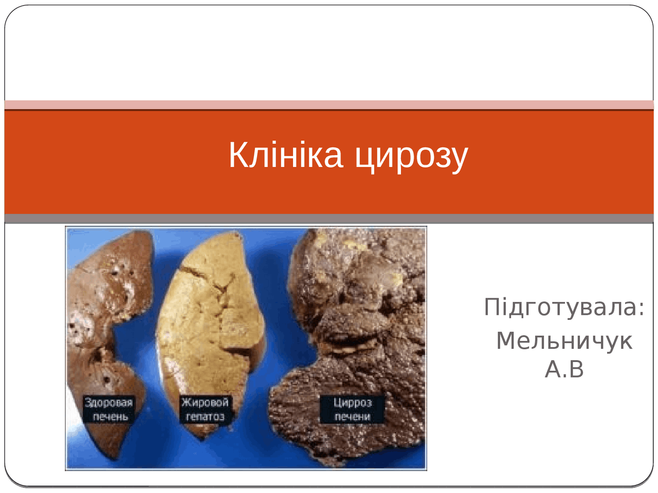 Презентація з терапії по клініці цирозу Docsity