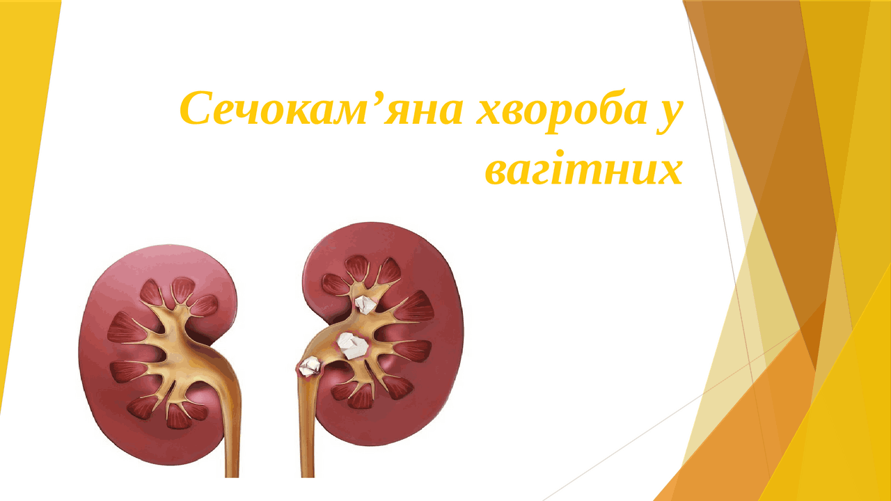 мочекаменная болезнь при беременности Docsity