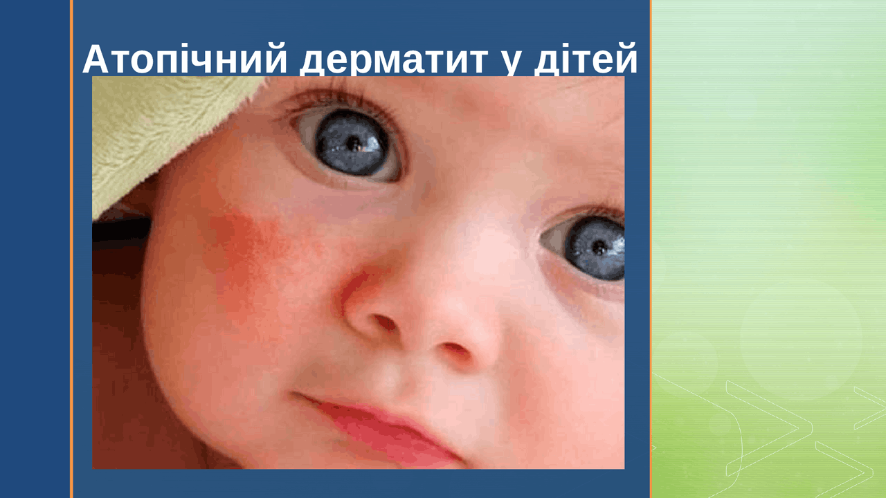 Атопический дерматит у детей Docsity