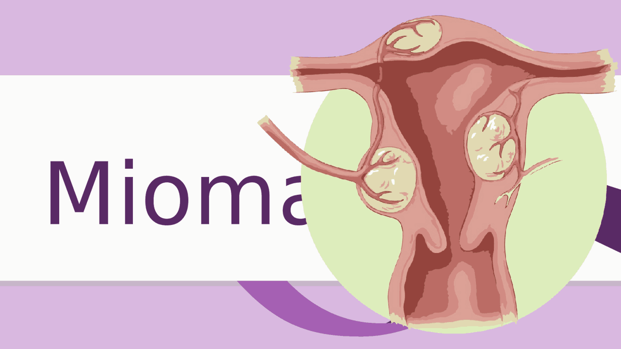 LEIOMIOMAS O MIOMAS (FIBROMAS) UTERINOS - Docsity