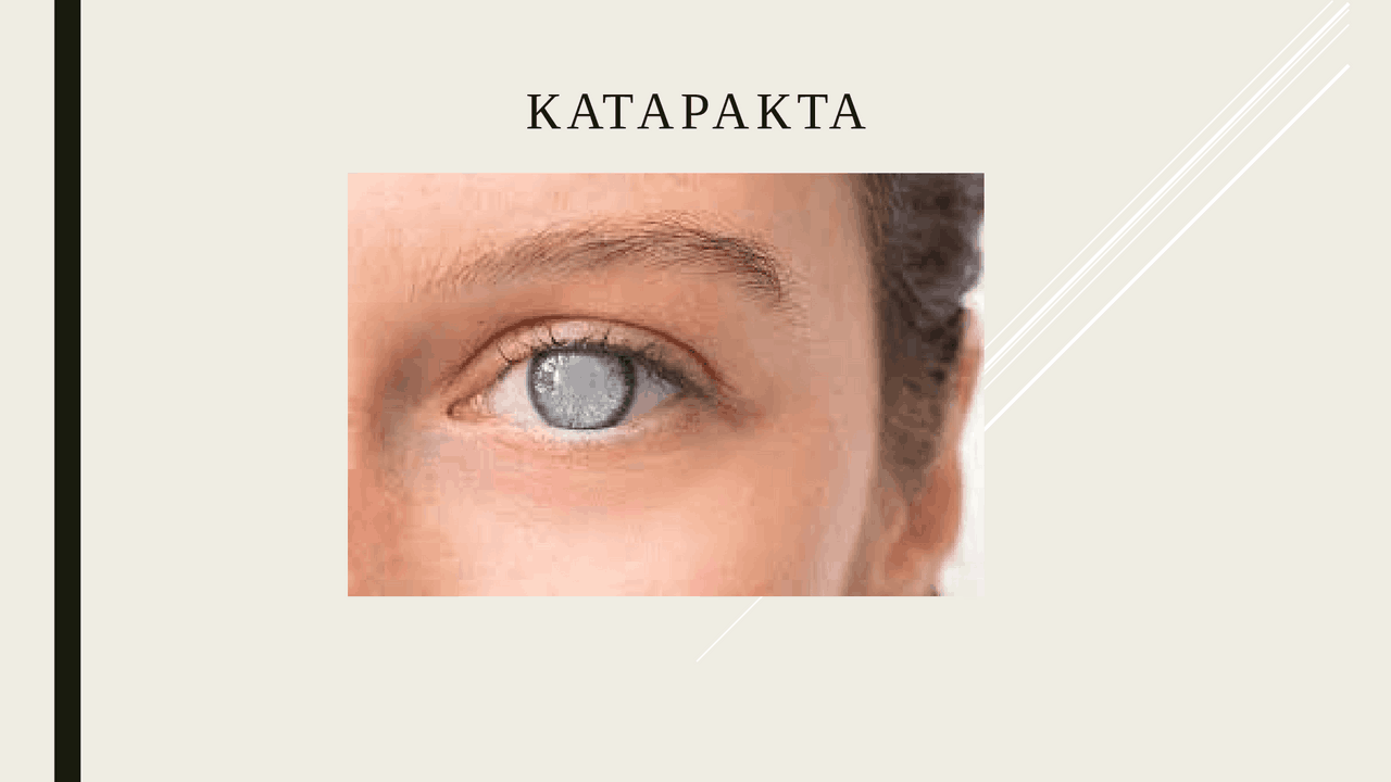 катаракта 4 курс нму презентація Docsity