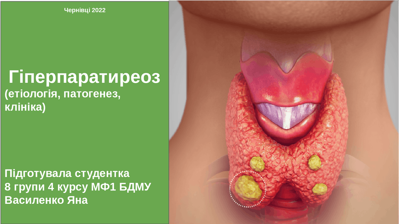 гіперпаратиреоз презентація на пару Презентации Эндокринология Docsity