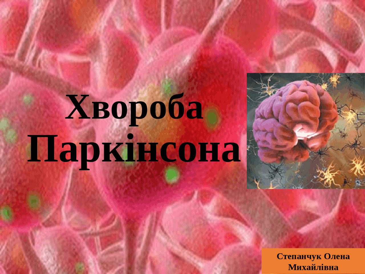 Хвороба Паркінсона неврологія Docsity