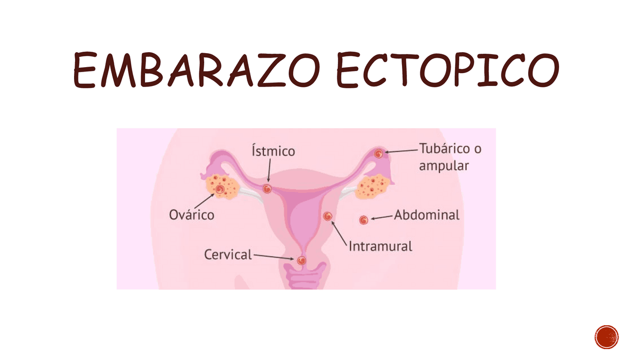 EMBARAZO ECTOPICO y tipos mas comunes. | Diapositivas de Obstetricia ...