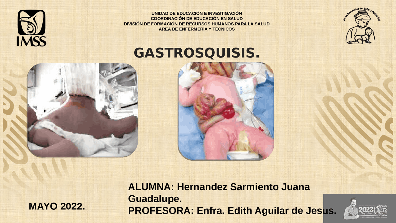 GASTROSQUISIS EN PEDIATRIA. | Diapositivas de Gastroenterología | Docsity