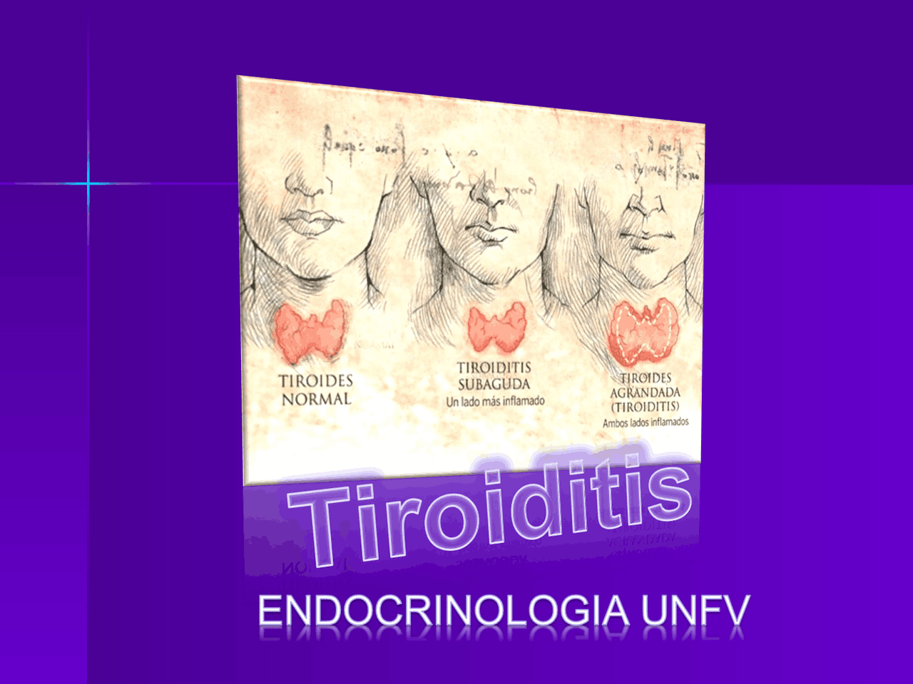 Tiroiditis agudas, subagudas y cronicas, endocrinologia | Diapositivas ...