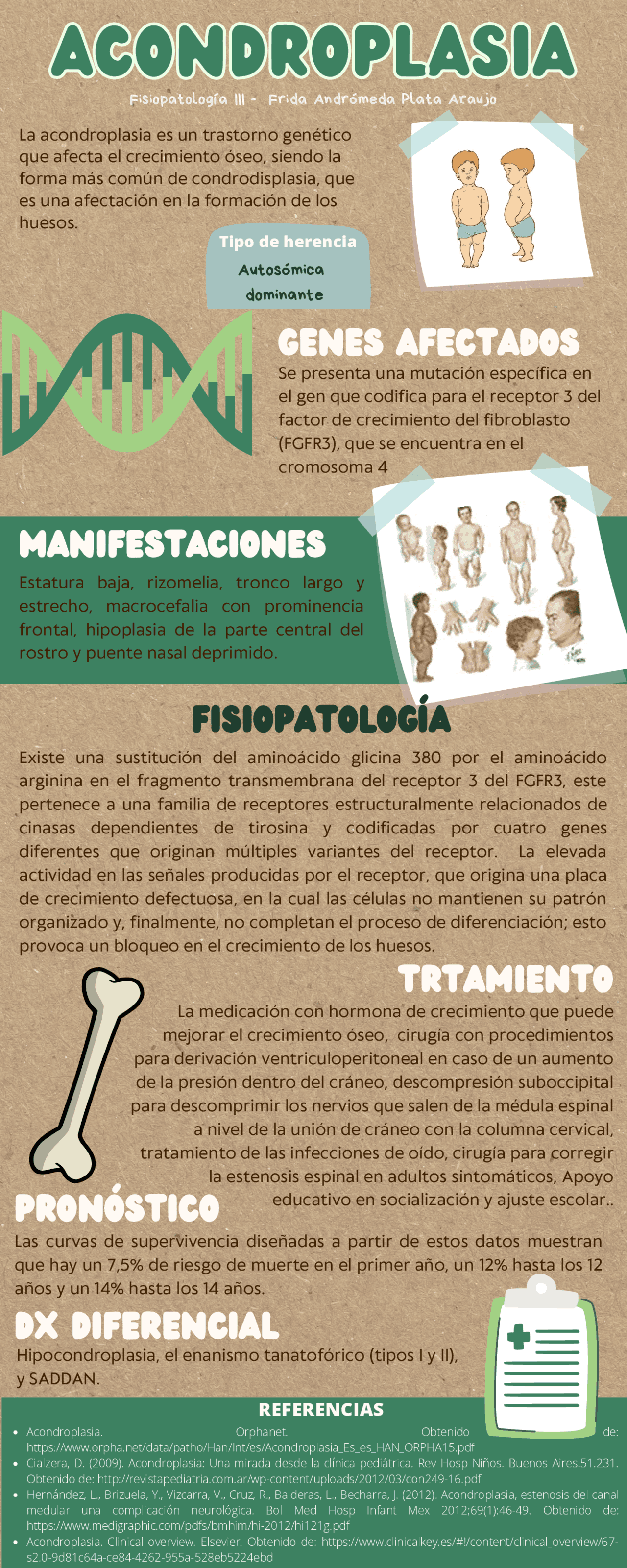 Enanismo Hipocondroplasia