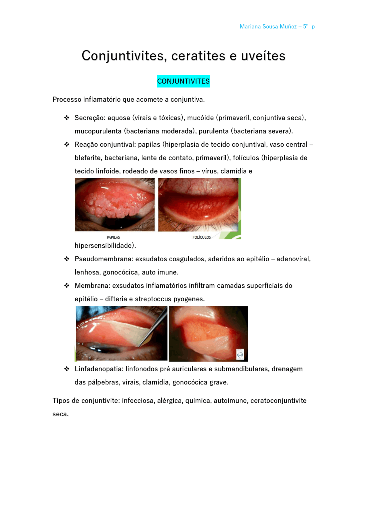 Foliculos De Conjuntivite Viral Conjuntivite: Causas, Tipos, Sintomas