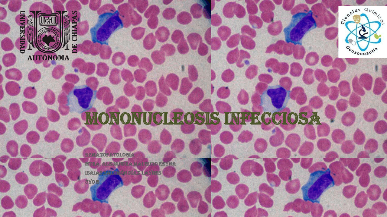 Mononucleosis Infecciosa Diapositivas De Hematología Docsity