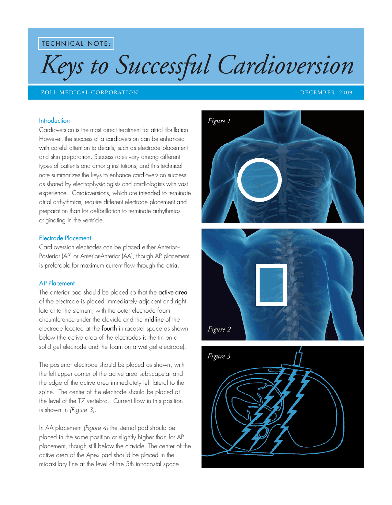 Tips for Successful Cardioversion: Electrode Placement & Atrial ...