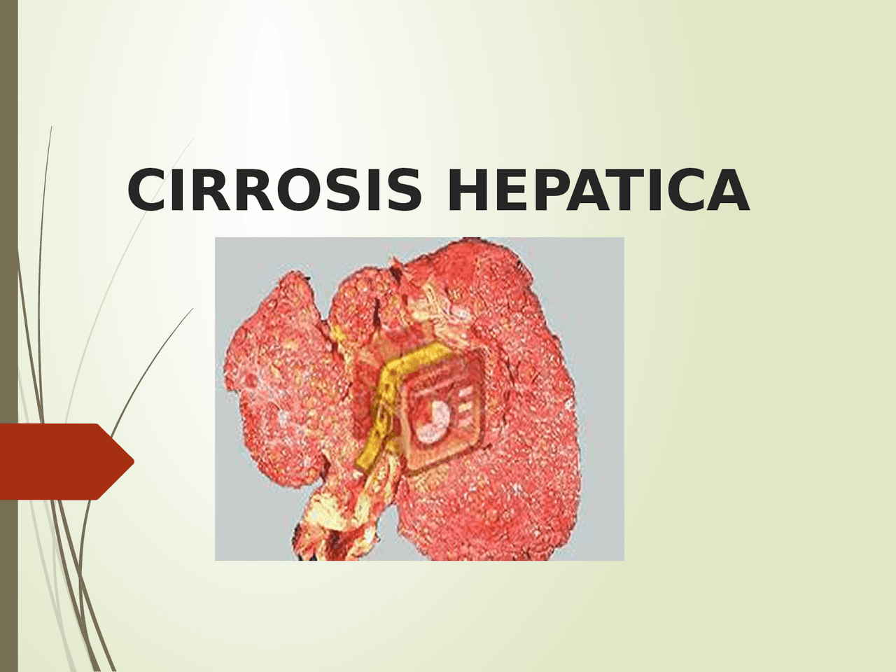 Diapositivas de cirrosis hepatica | Diapositivas de Gastroenterología - Docsity