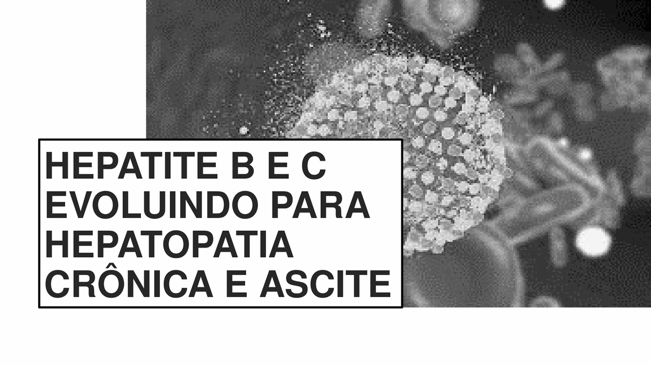 HEPATITE B E C EVOLUINDO PARA HEPATOPATIA CRÔNICA E ASCITE | Slides ...