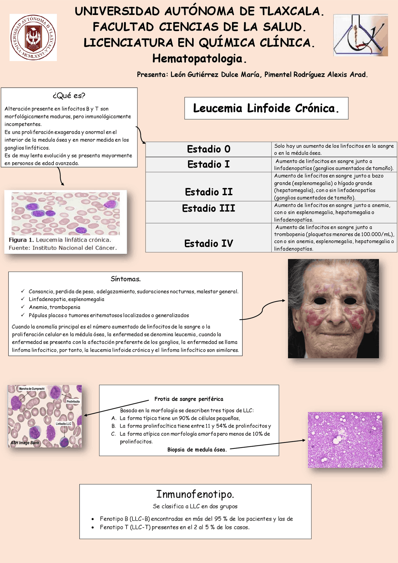 Leucemia Linfoide Cronica | Monografías, Ensayos de Hematología | Docsity