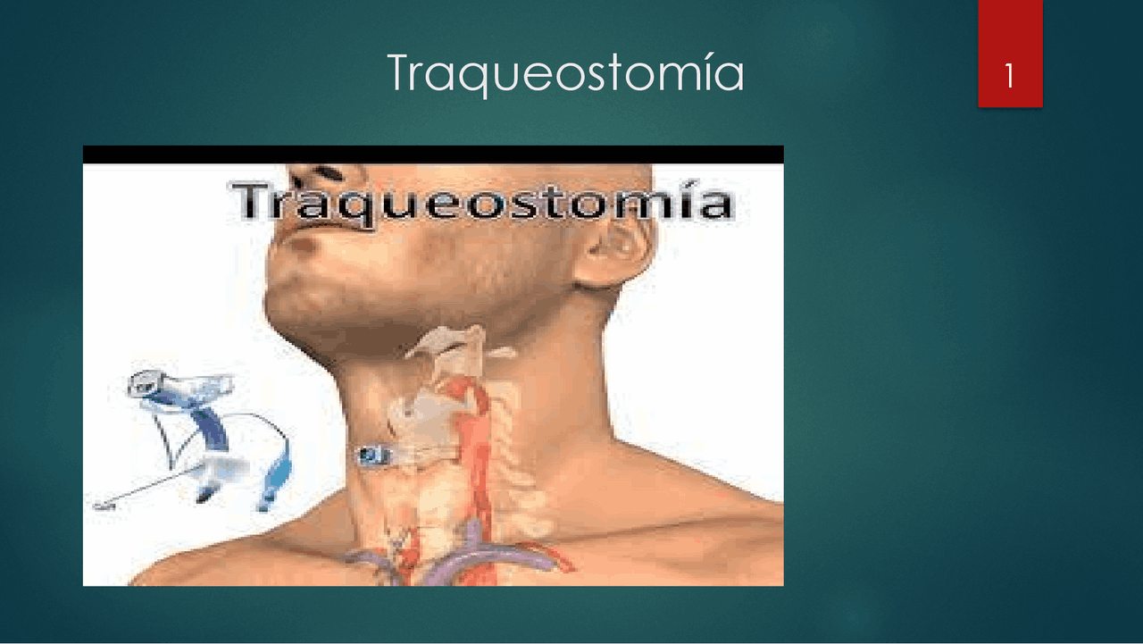 Traqueotomía y cx laringectomia | Diapositivas de Ciencias Aplicadas a ...