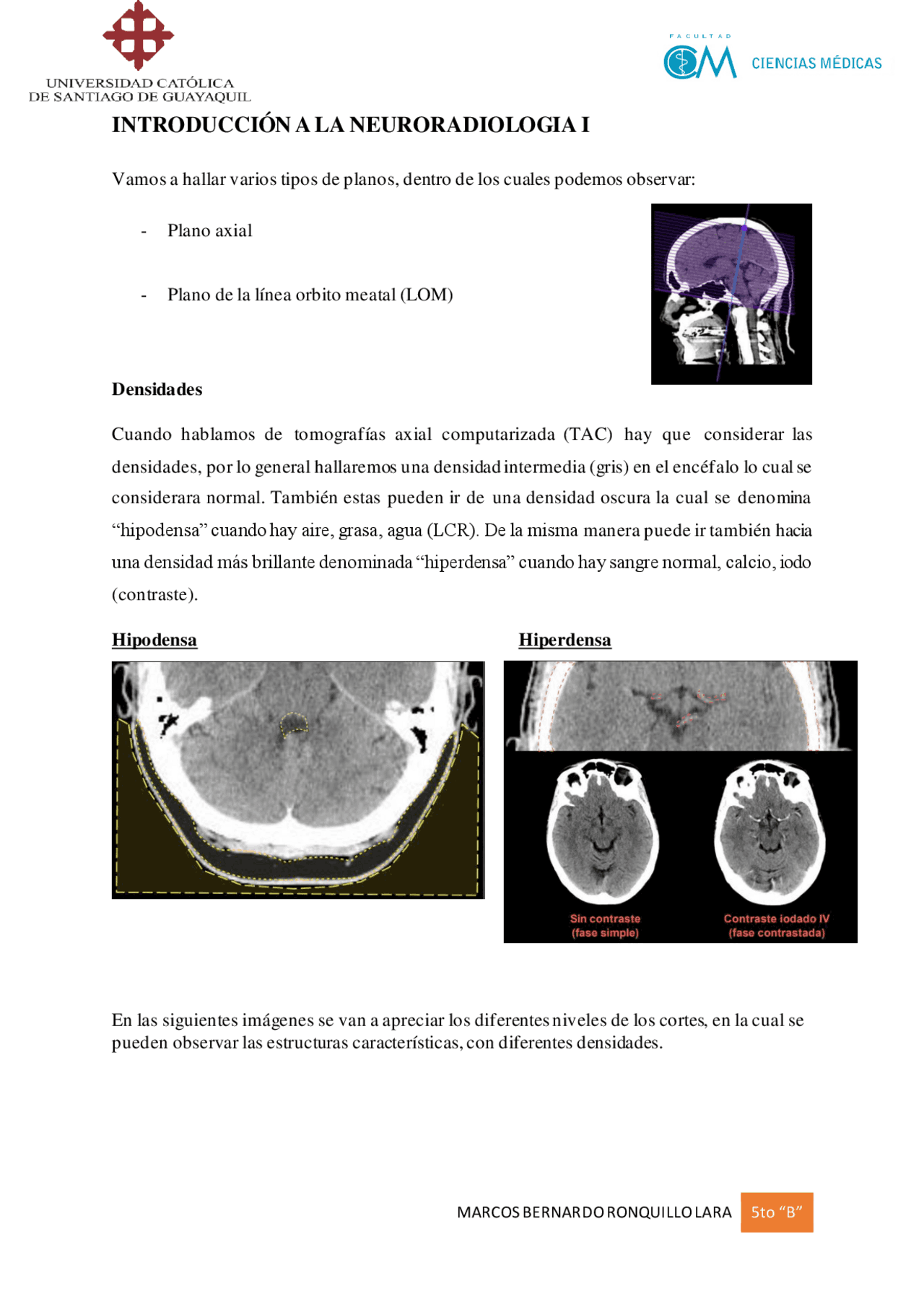 Introducción A La Neuroradiologia Resúmenes De Radiología Docsity