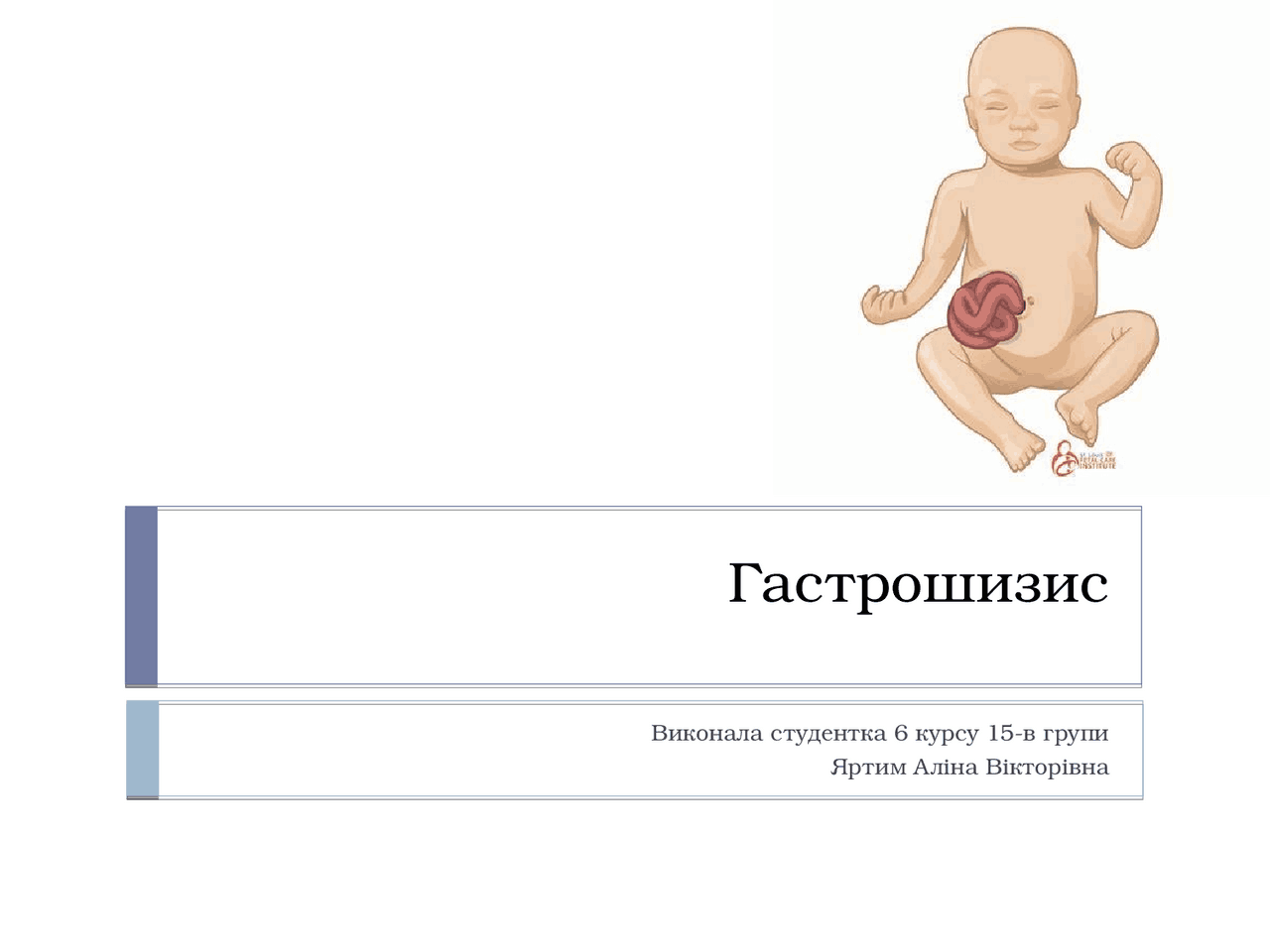 Гастрошизис у дітей та методи його лікування Презентации Детская