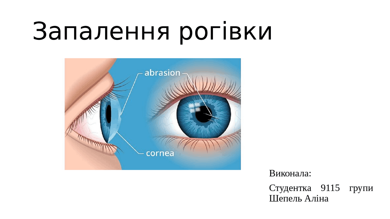Захворювання рогівки Презентации Офтальмология Docsity