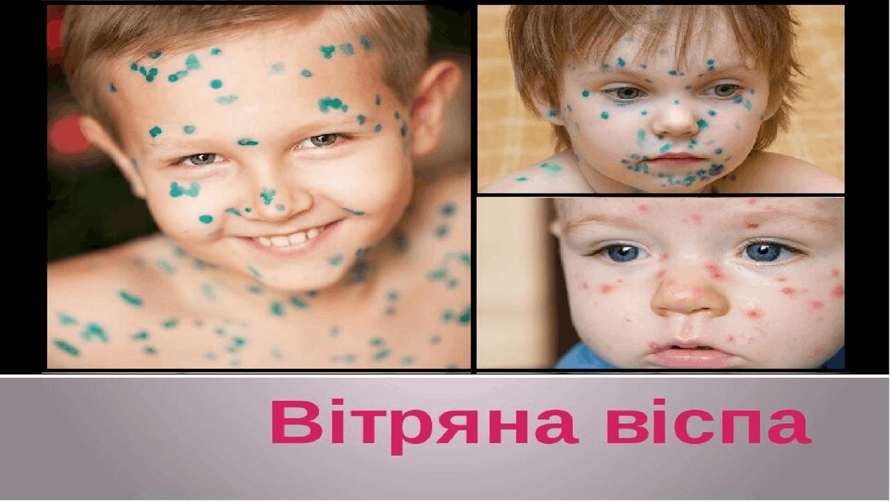 Вітряна віспа дайте 10 балів будь ласка Презентации Математика Docsity