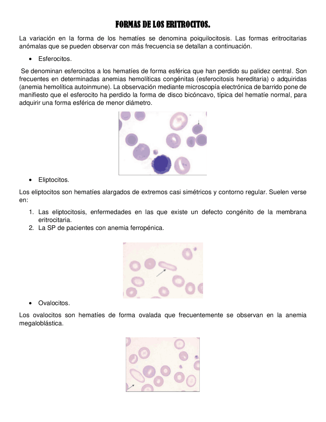 Poiquilocitosis, forma de los eritrocitos. | Esquemas y mapas ...