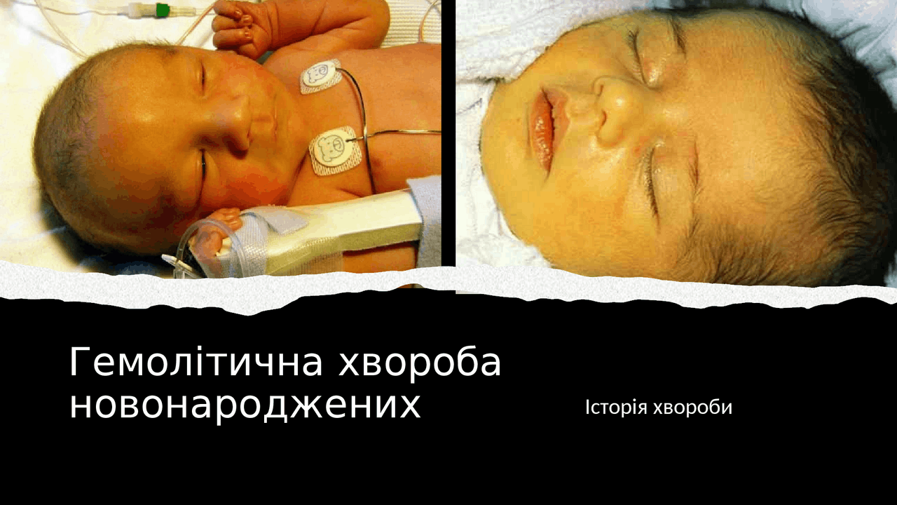 історія хвороби гемолітична хвороба Схемы Педиатрия Docsity