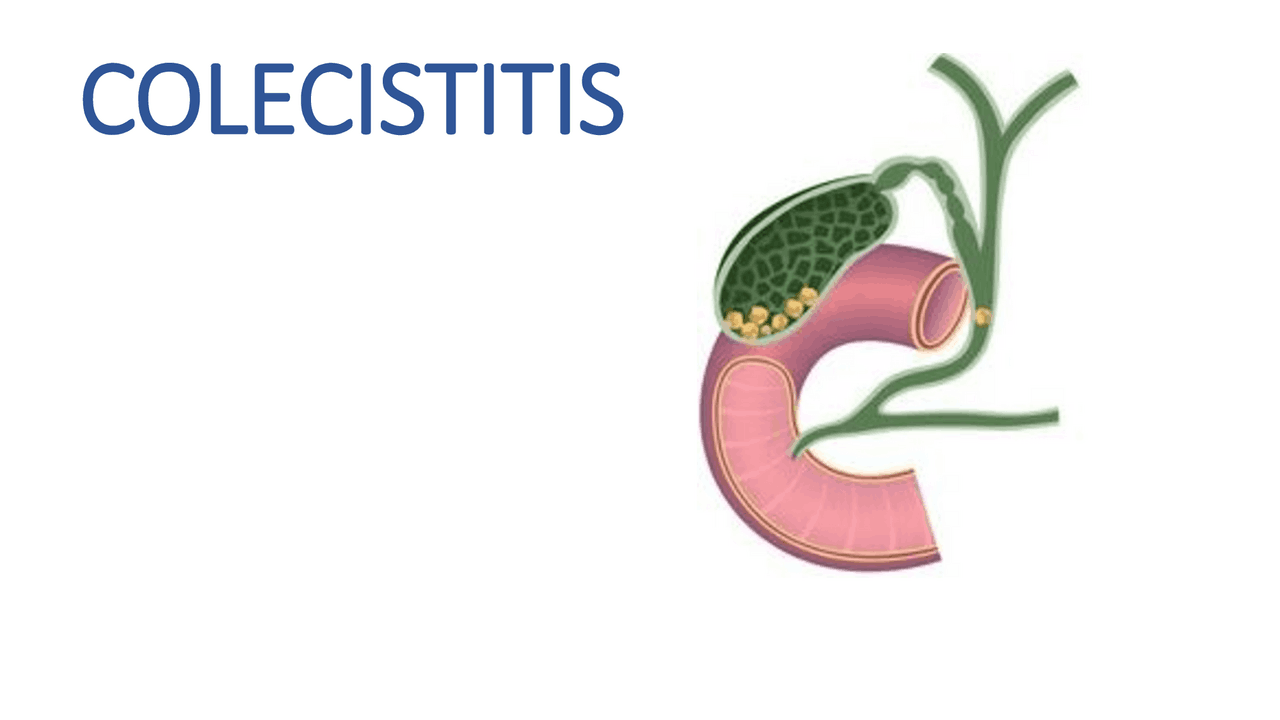 Colecistitis cronica calculosa | Esquemas y mapas conceptuales de ...