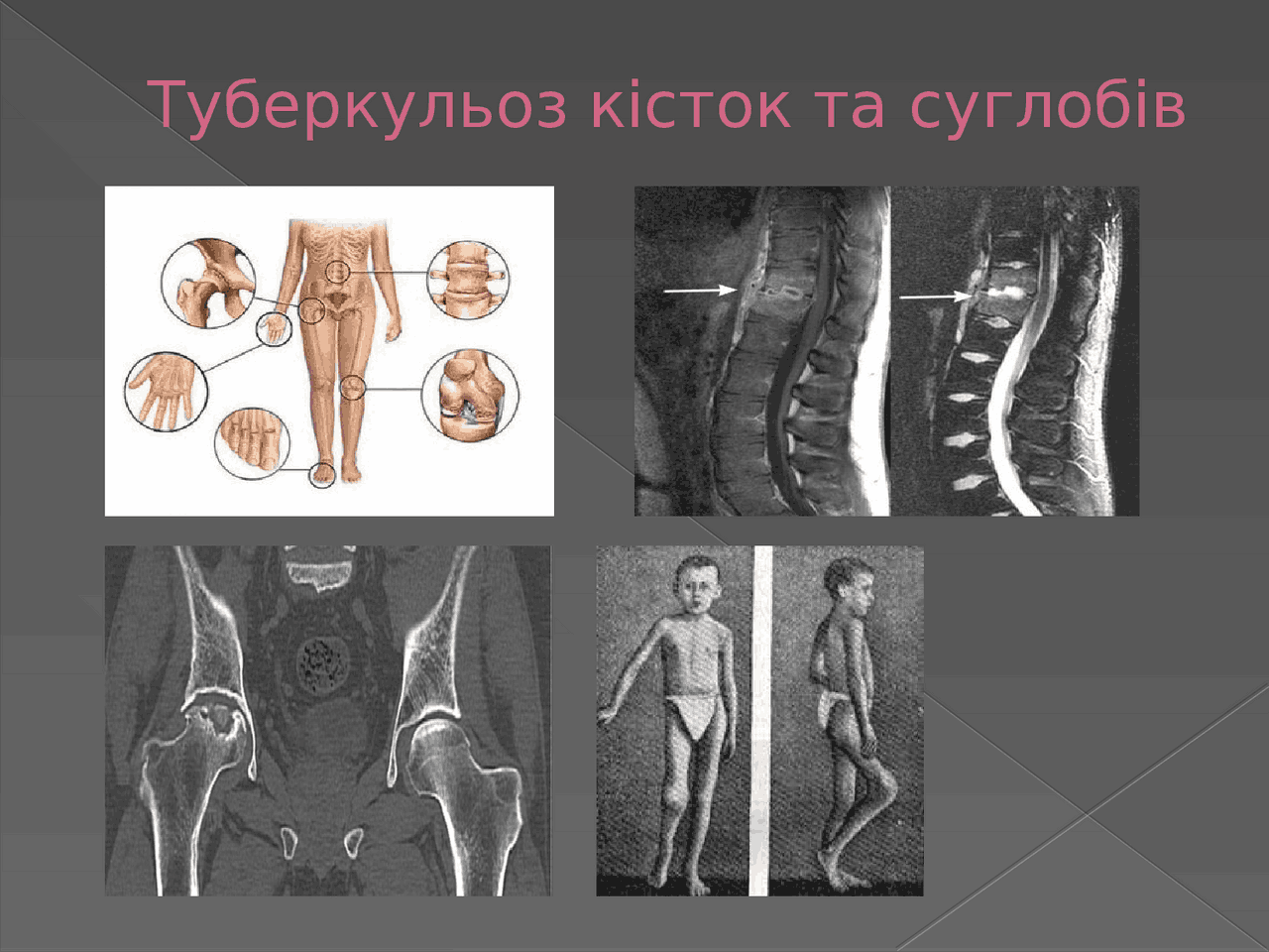ПрезентаціяТуберкульозний артрит Презентации Травматология Docsity