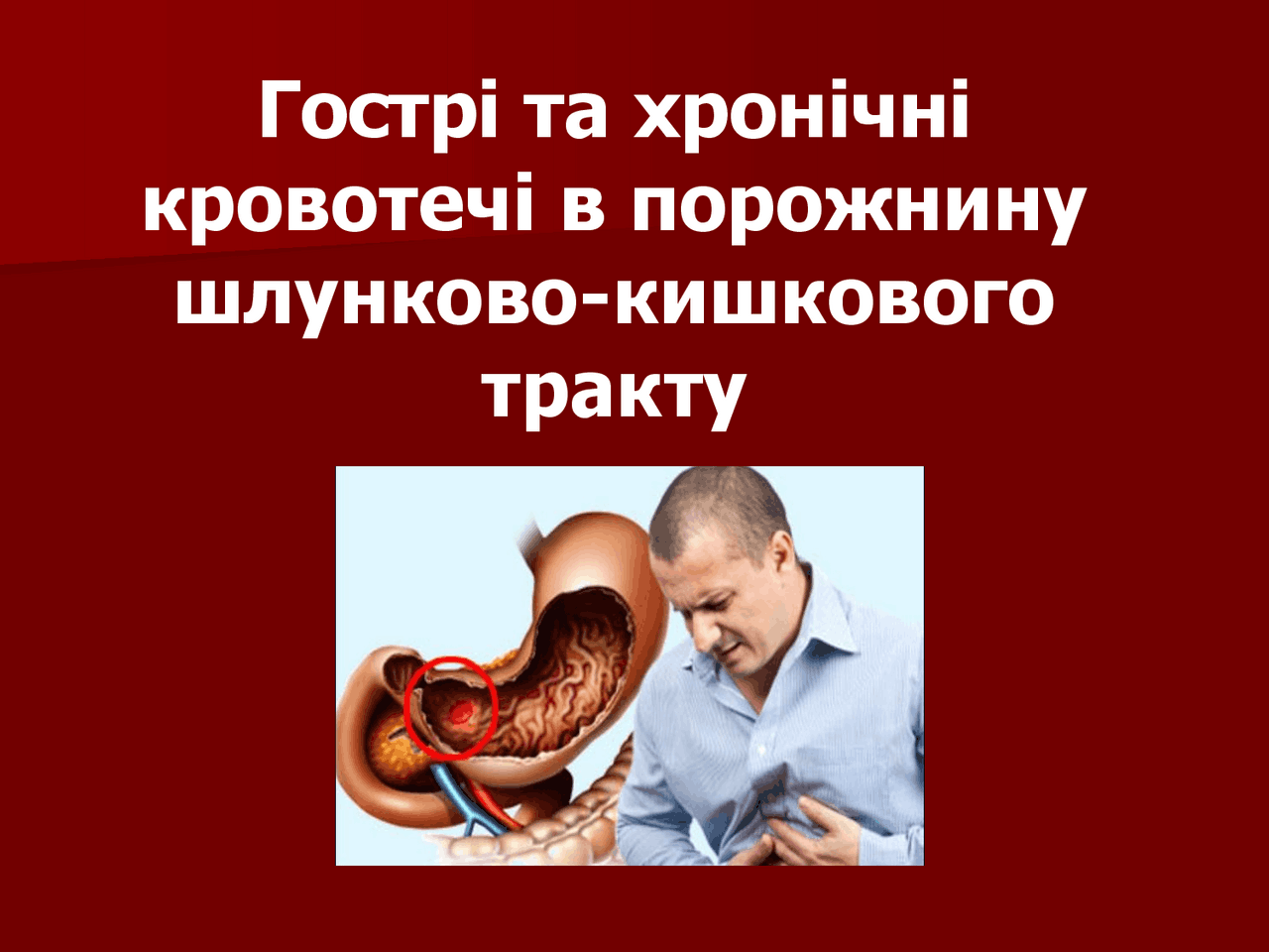 Кишкові кровотечі 4 курс Схемы Хирургия Docsity