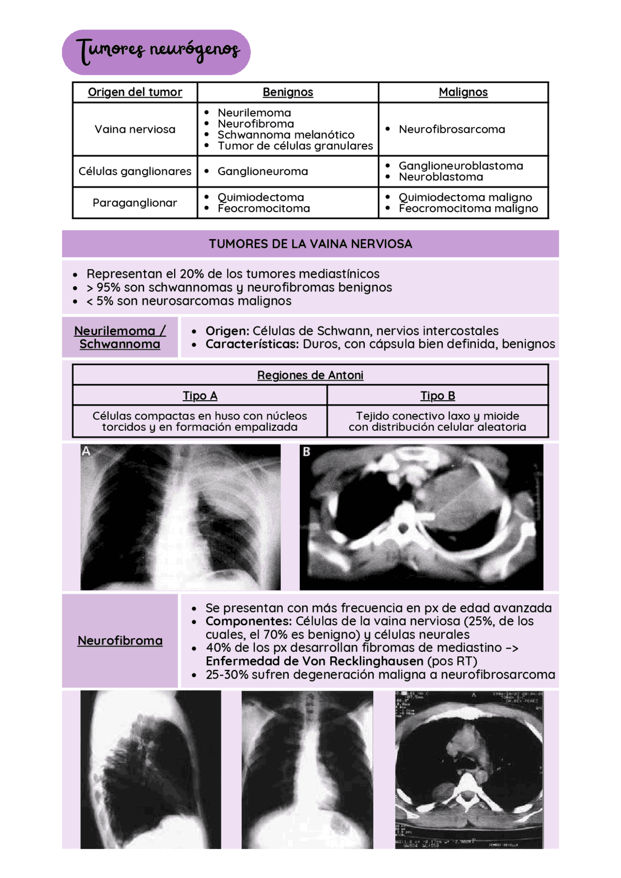 Tumores Neurógenos De Mediastino Apuntes De Neumología Docsity