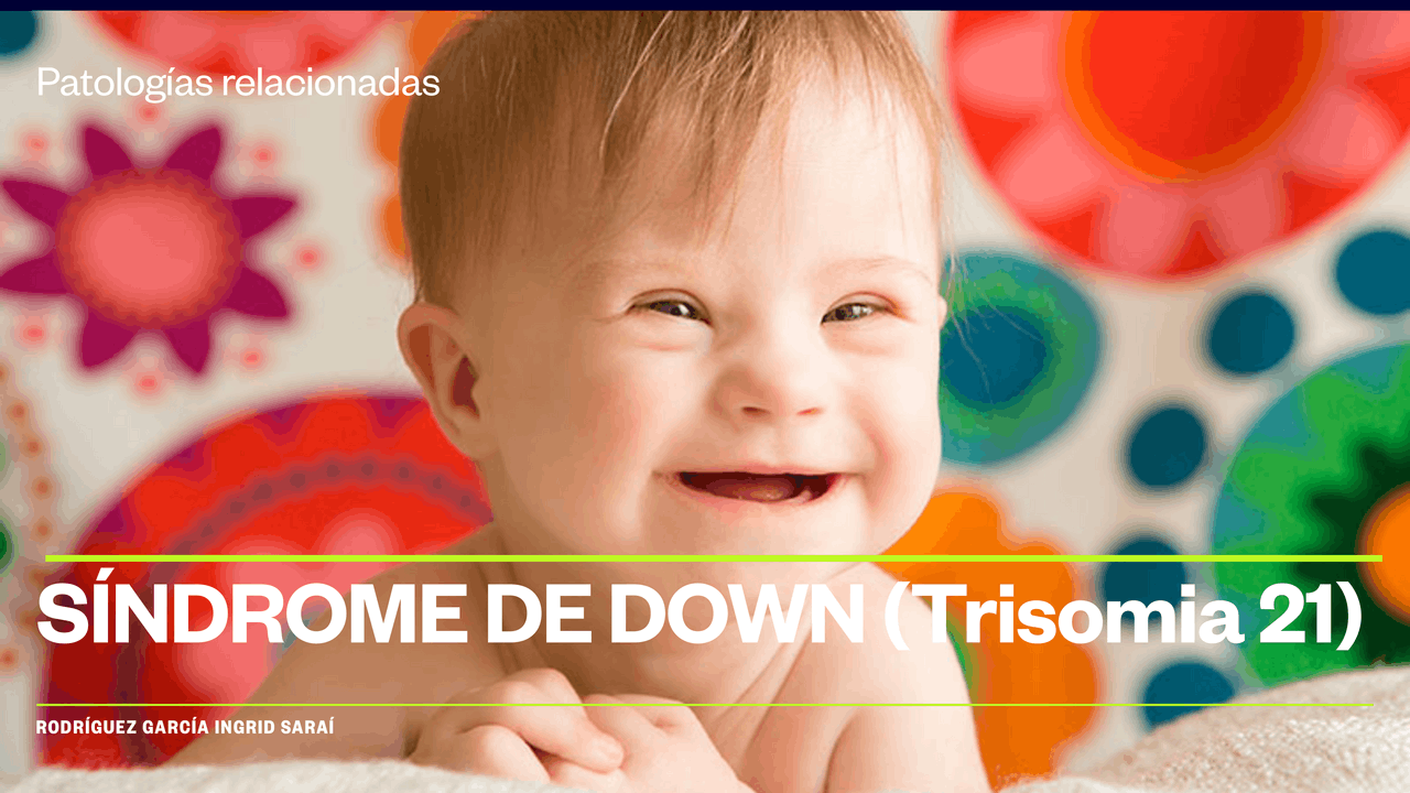 Trisomia 21 síndrome de down | Diapositivas de Medicina | Docsity