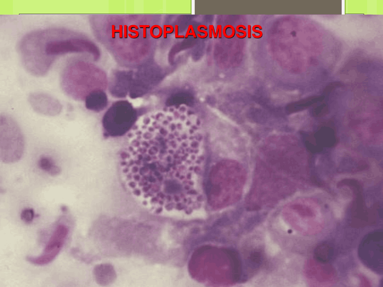 La histoplasmosis es una enfermedad infecciosa causada por la ...