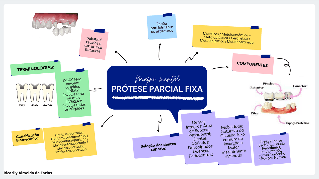 Mapa Mental Prótese Parcial Fixa | Exercícios Odontologia | Docsity